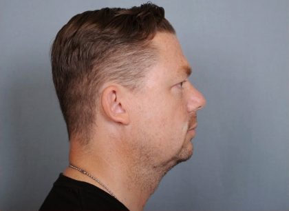 Patient #672 Chin Implants Before and After Photos New Bern, NC ...