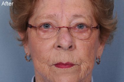 Patient #820 Reconstruction Before and After Photos New Bern, NC ...