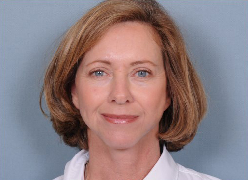 Patient #913 Facelift Before and After Photos New Bern, NC - Plastic ...