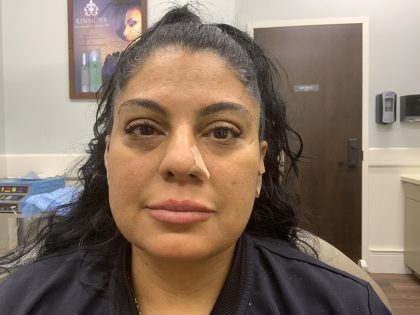 Patient #3728 Dimple Creation Before and After Photos New Bern, NC ...