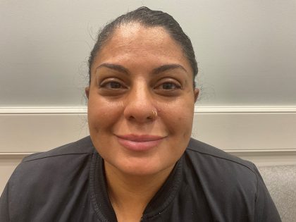 Patient #3728 Dimple Creation Before and After Photos New Bern, NC ...